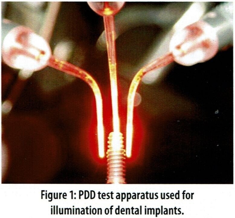 Periowaveの臨床応用その⑥ 重度のインプラント周囲炎の対応とインプラント体の基礎研究｜東邦歯科診療所