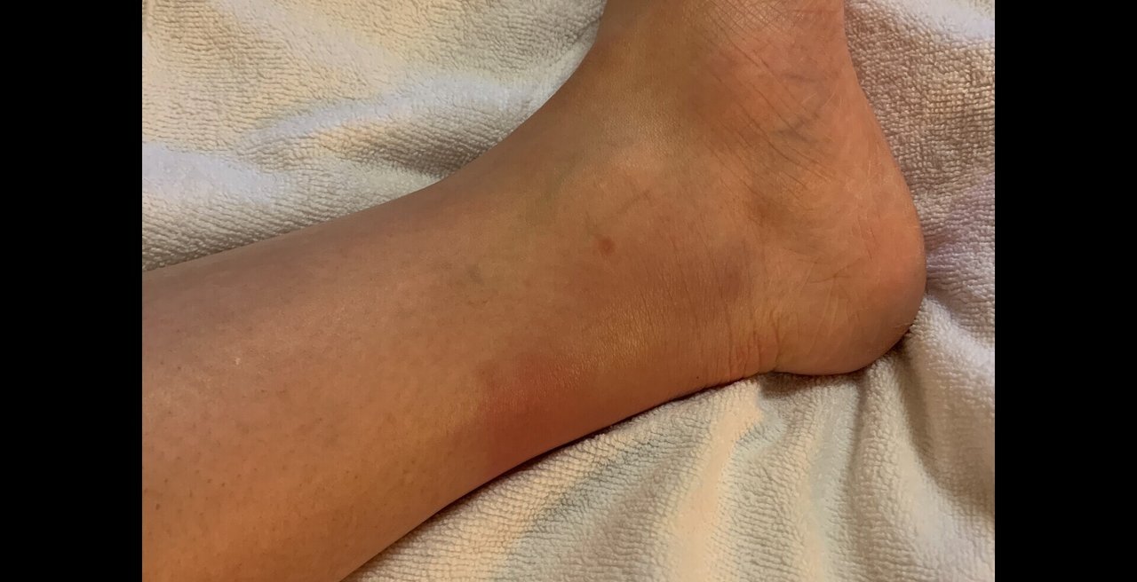 アキレス腱周囲炎について｜YUKO KURATA