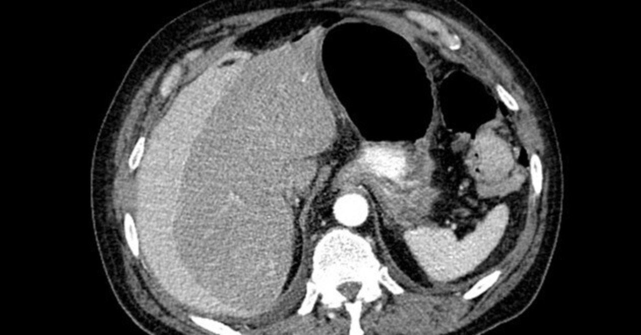 ショックの画像診断/CT hypoperfusion complex｜TKG画像診断