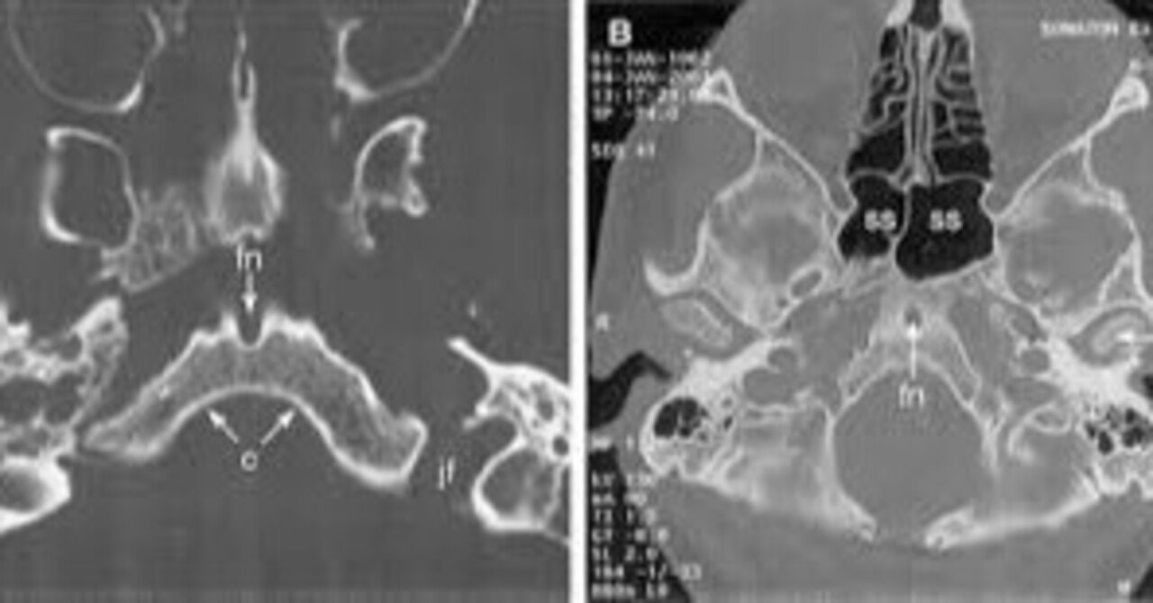 Fossa Navicularis Magna｜TKG画像診断｜note