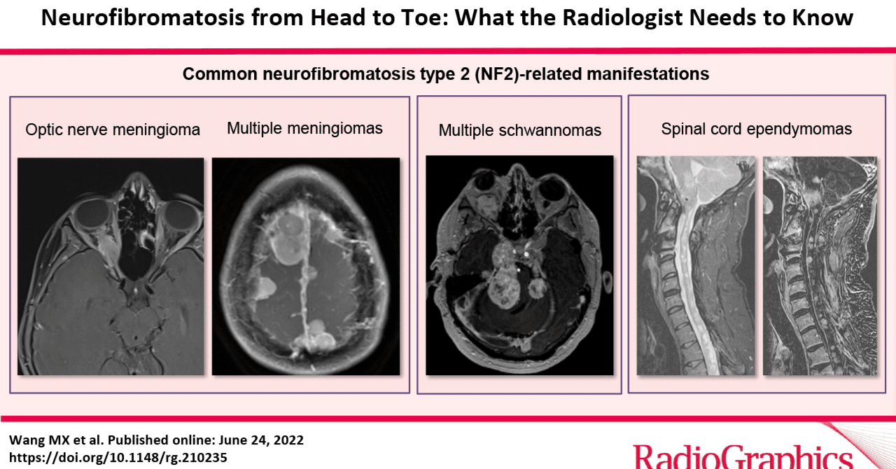 NF2の特徴,改訂診断基準｜TKG画像診断