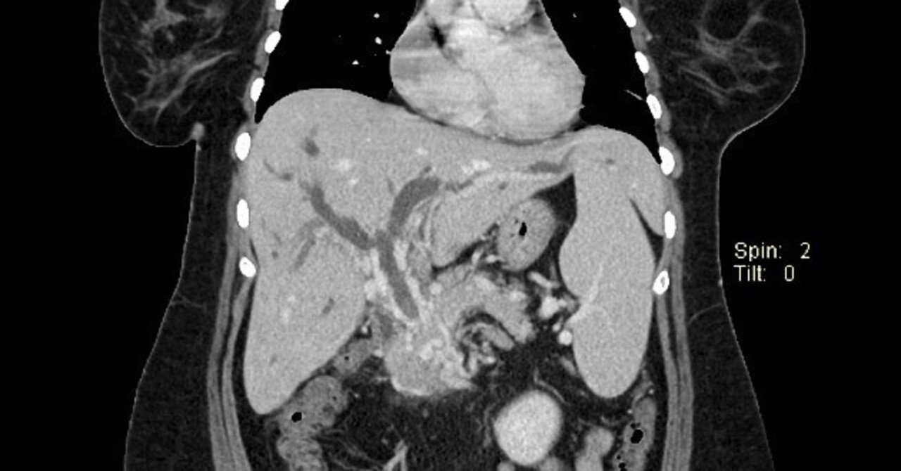 portal biliopathy｜TKG画像診断｜note