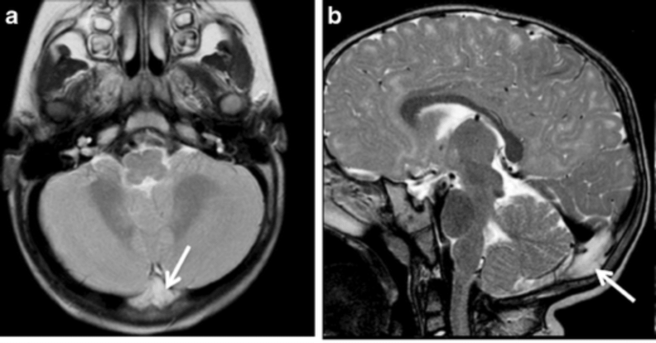 Torcular pseudomass｜TKG画像診断