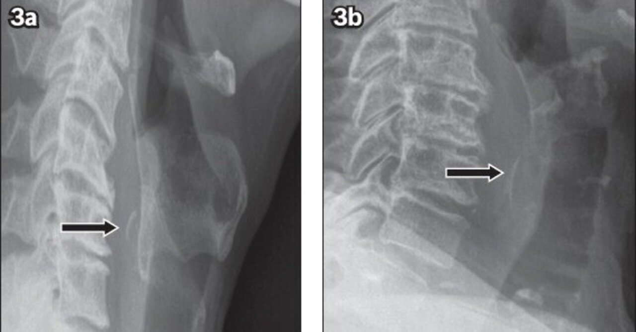 魚骨と間違えるな！輪状軟骨骨化｜TKG画像診断