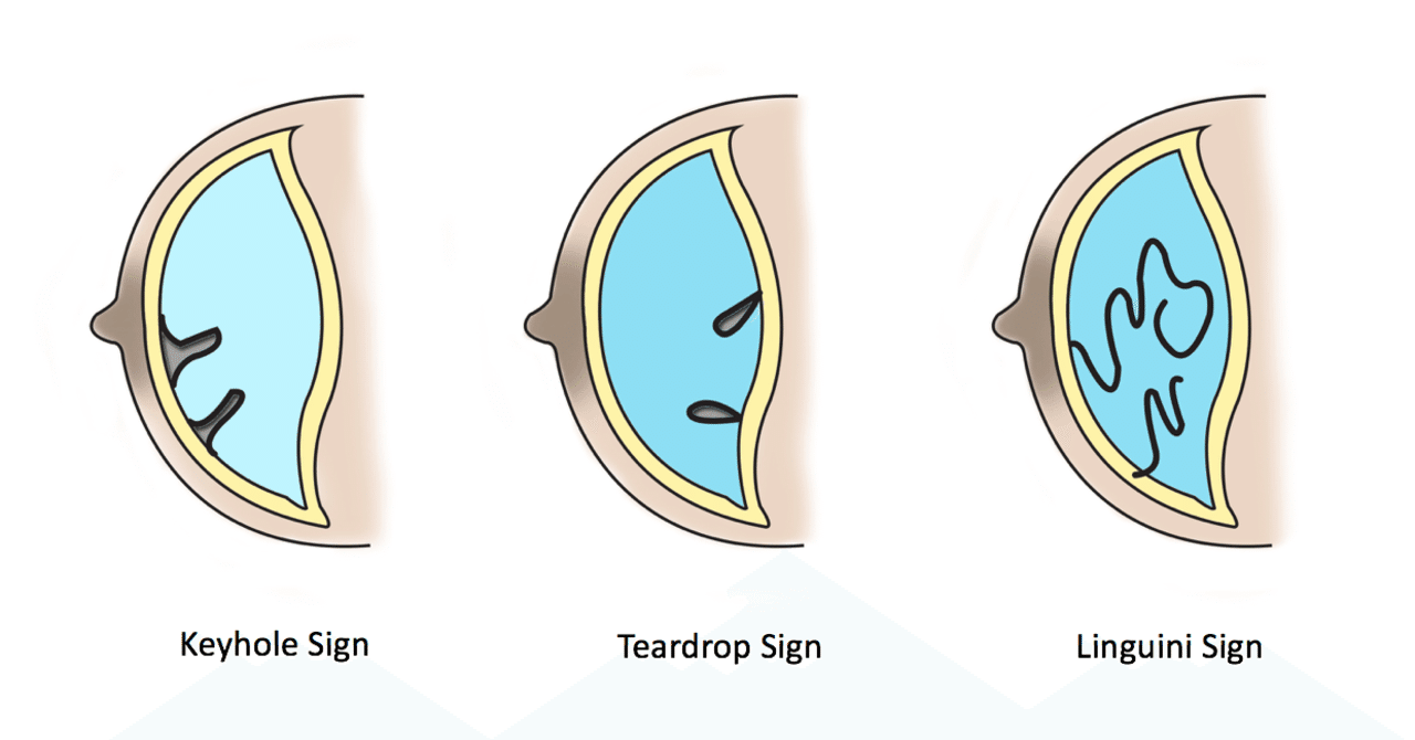 乳房インプラントのintracapsular ruptureのサイン｜TKG画像診断