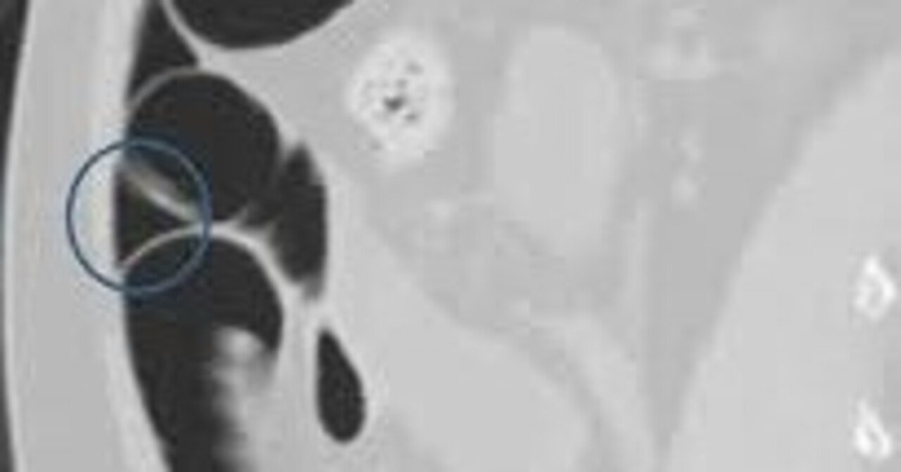 Telltale triangle sign｜TKG画像診断