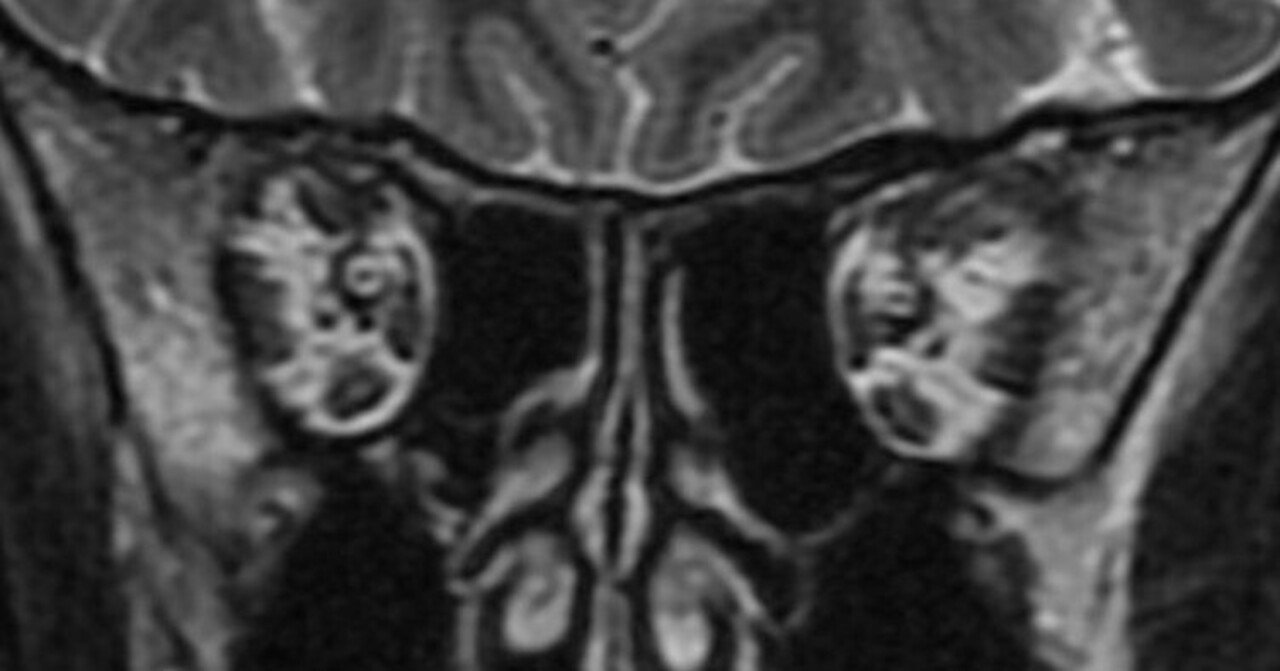 Wolfram症候群｜TKG画像診断｜note
