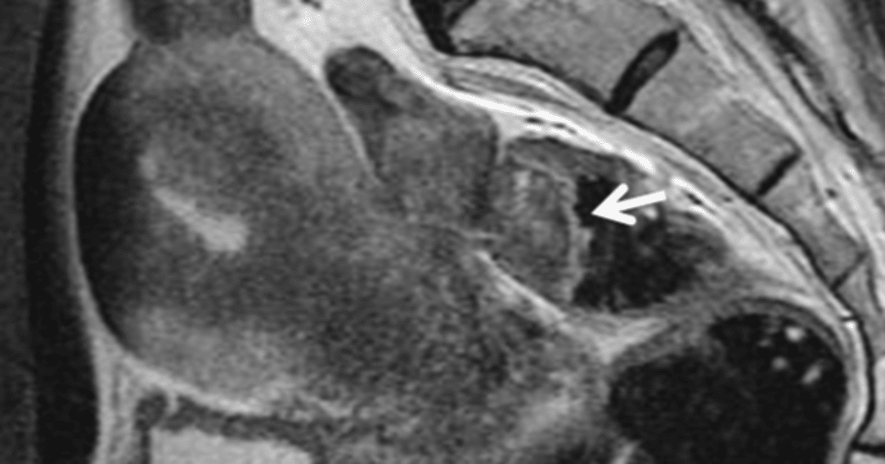 mushroom cap sign｜TKG画像診断