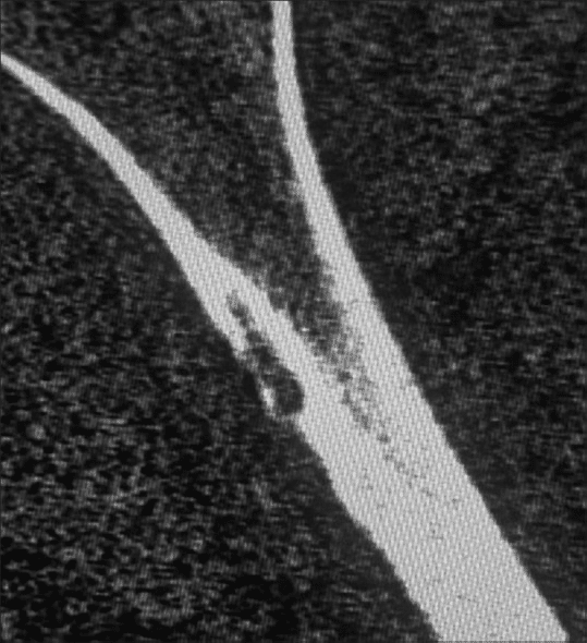 Pseudotumor Deltoideus｜TKG画像診断｜note