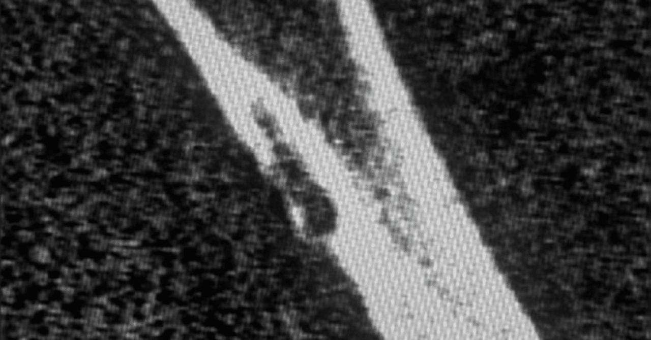 Pseudotumor Deltoideus｜TKG画像診断｜note