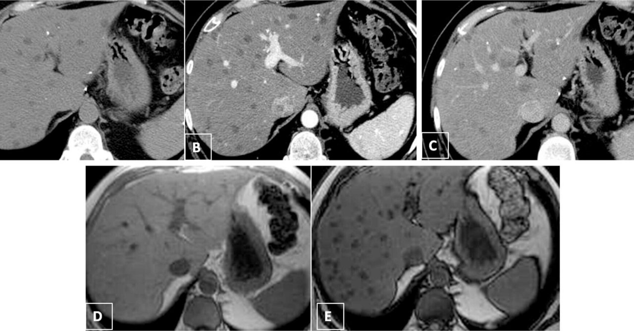 Multifocal nodular hepatic steatosis｜TKG画像診断｜note