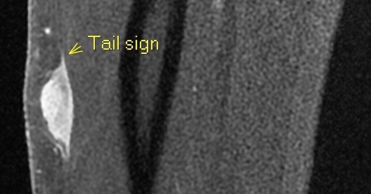 Fascial tail sign｜TKG画像診断