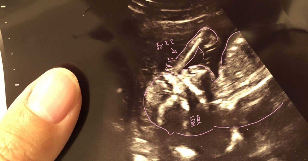 【19w6d】お腹痛いから予約外受診してみたら｜愛