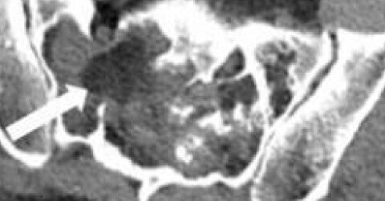 Primary intraosseous psammomatous melanotic schwannoma of the sacrum｜TKG画像診断｜note