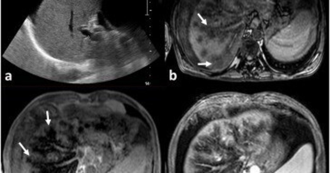 Perivenous Hepatic Iron Deposition｜TKG画像診断｜note