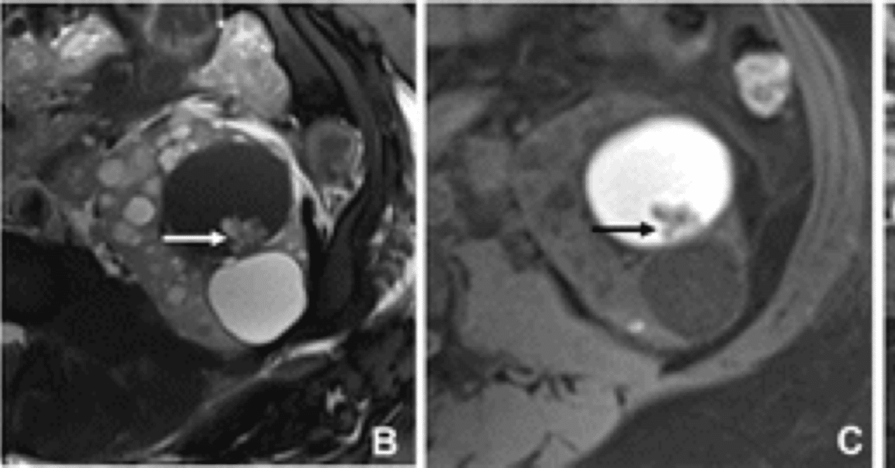 Malignancy in ADPKD｜TKG画像診断｜note