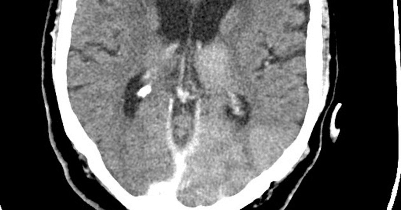 造影剤脳症｜TKG画像診断