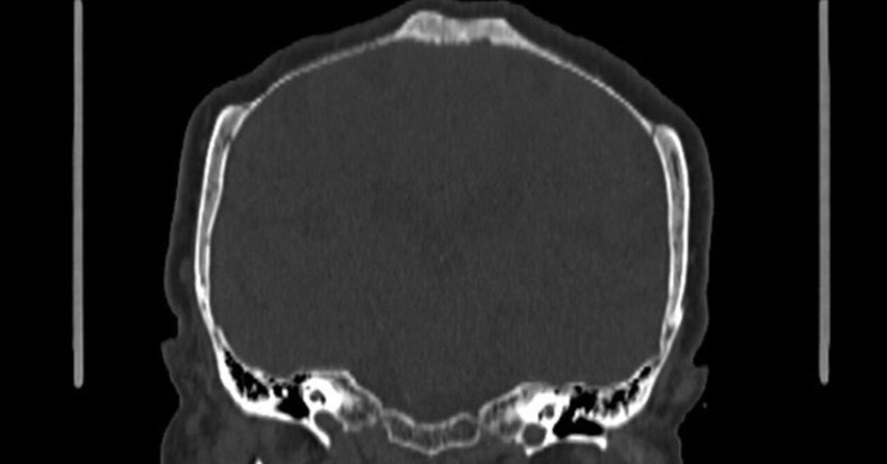 biparietal osteodystrophy｜TKG画像診断