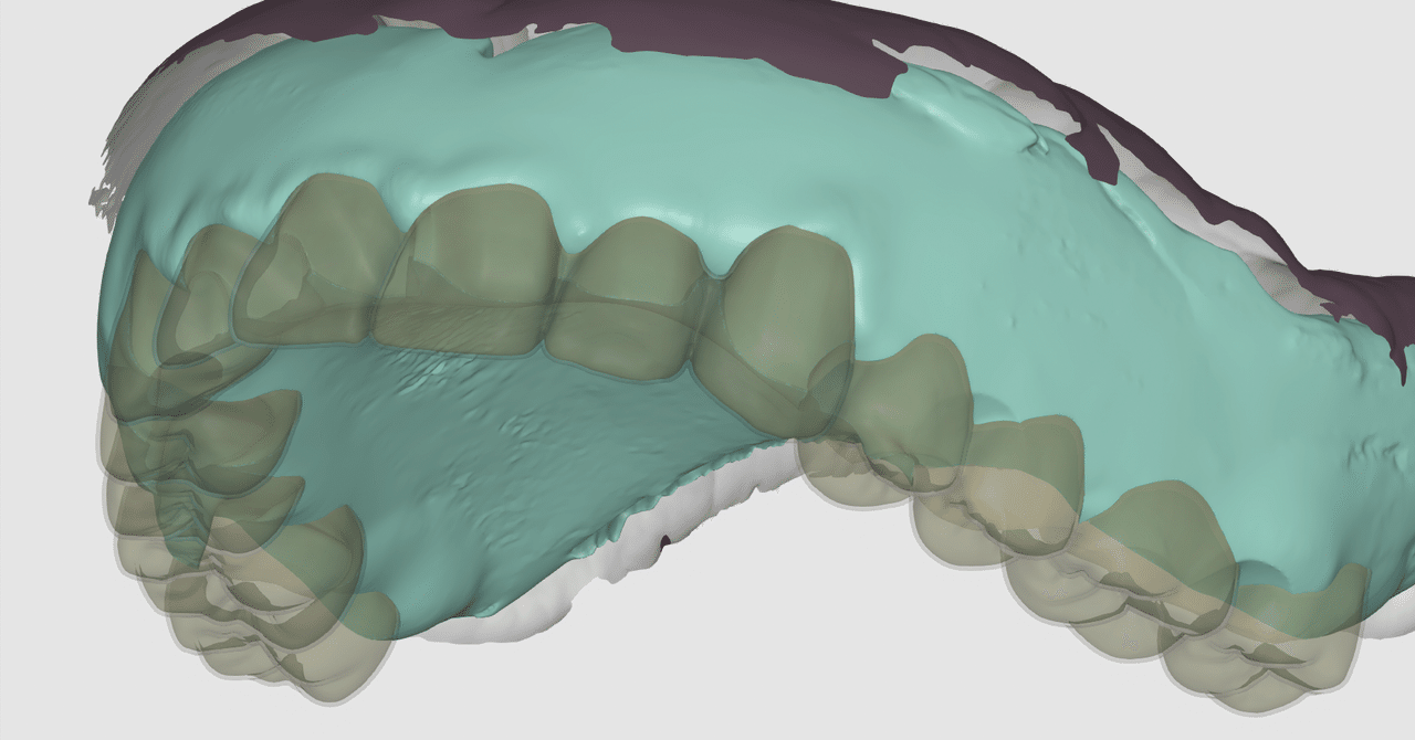 Medit Designで作成する3Dプリントデンチャー｜3D歯科