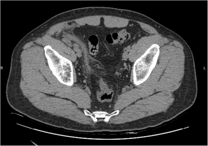 Vasitis(精管炎):鼠径ヘルニアのmimicker｜TKG画像診断
