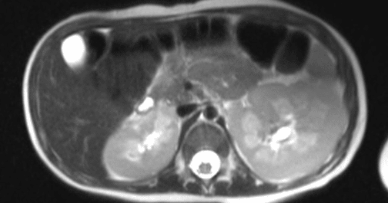 diffuse nephroblastomatosis｜TKG画像診断｜note